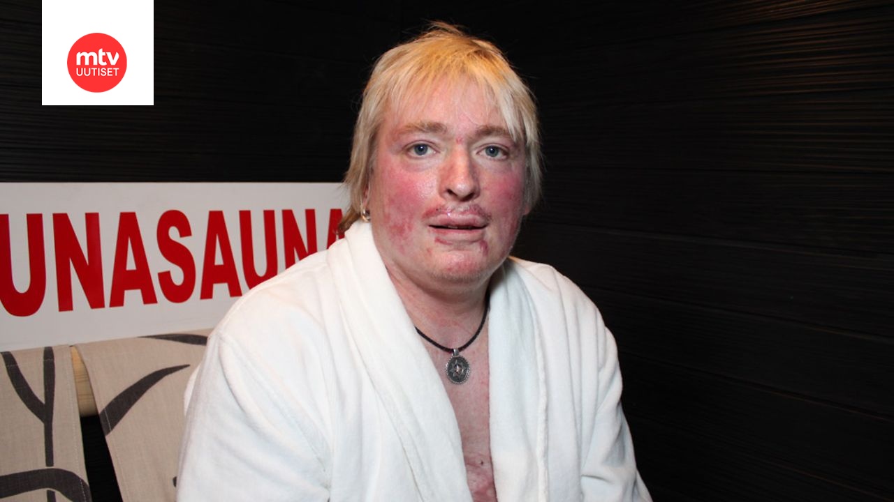 Sauna-Timo: Nyt voin vihdoin hymyillä kivutta | MTV Uutiset
