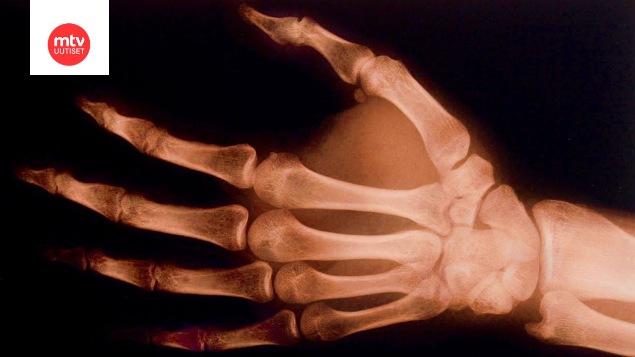 HS: Suosittu osteoporoosilääke saatetaan vetää pois markkinoilta | MTV ...
