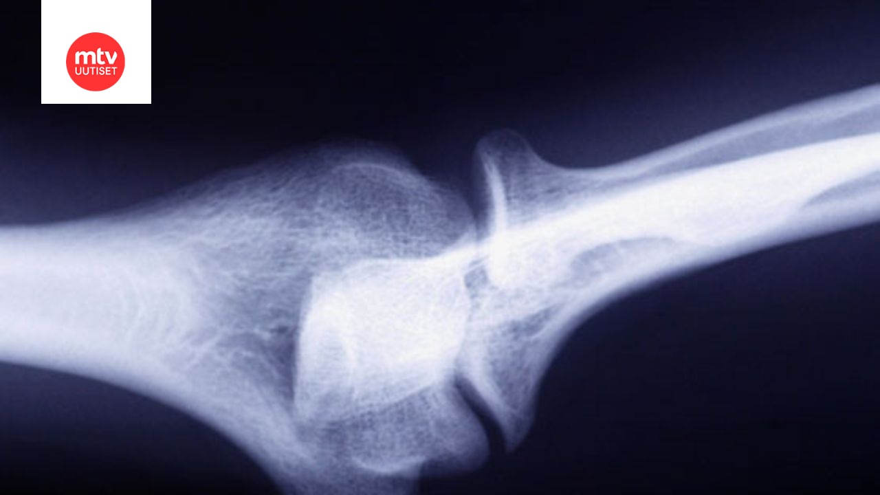 Luut paljastavat ruumiista paljon | MTV Uutiset