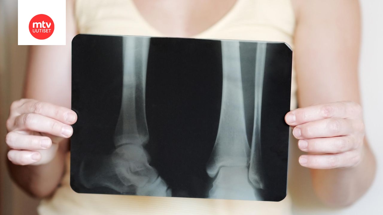 Voit sairastaa osteoporoosia tietämättäsi – vain yksi näkyvä merkki ...