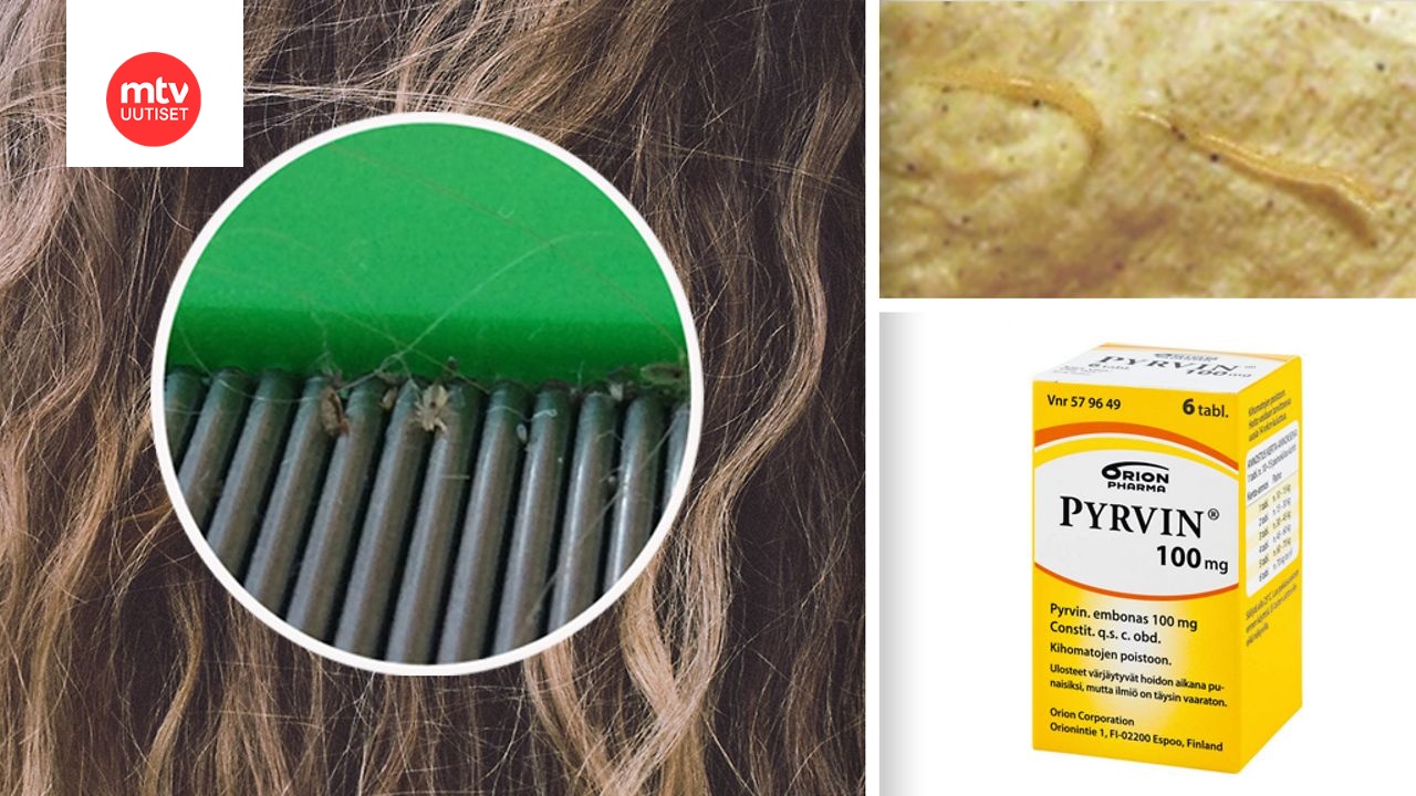 Täi- ja kihomatoepidemiat aiheuttavat uuvuttavan siivous- ja ...