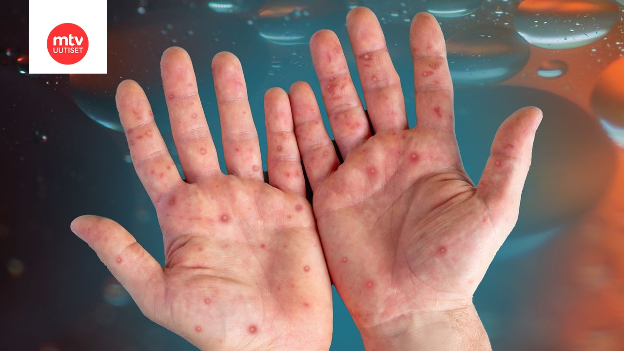 Suomussalmella tulirokkotartuntoja | MTV Uutiset