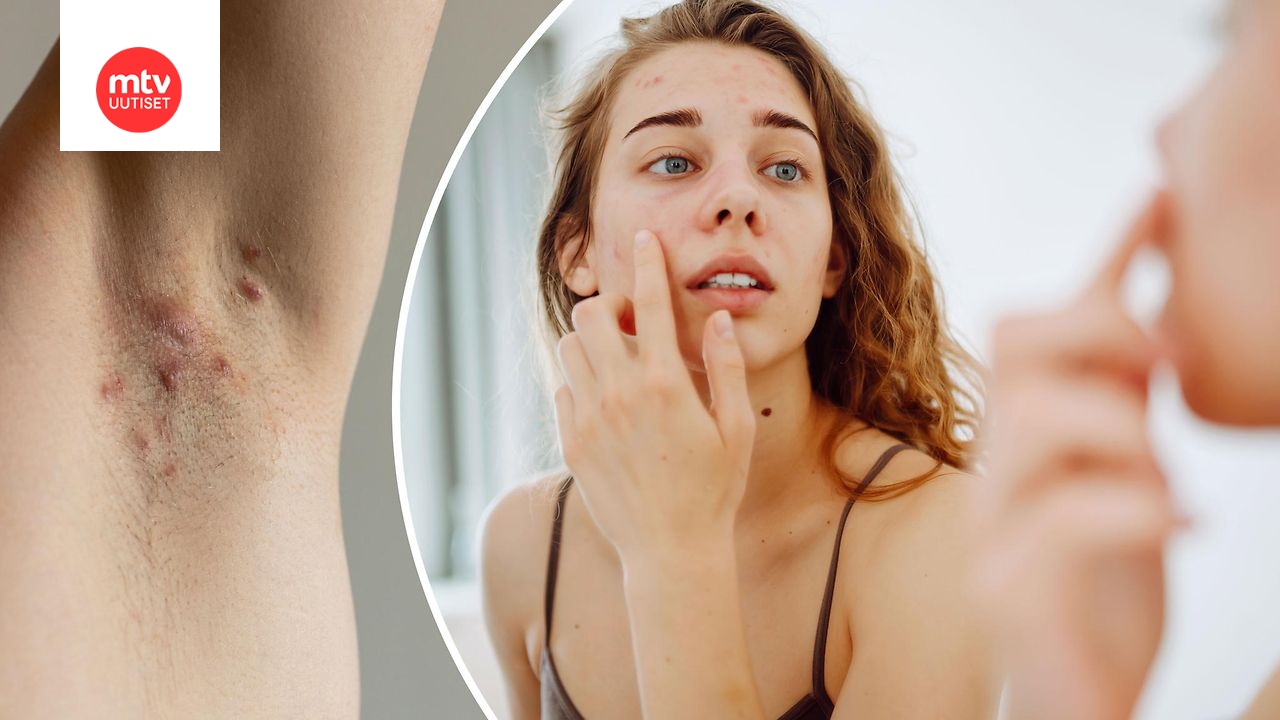 HS-tauti on luultua yleisempi ihosairaus | MTV Uutiset