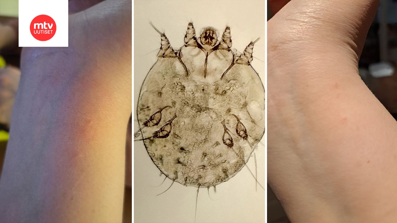 Näin pääset eroon syyhypunkista | MTV Uutiset