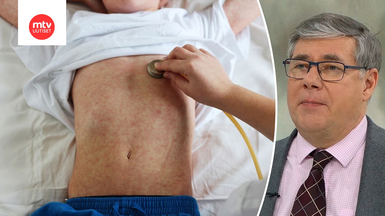 Voiko Suomeen iskeä tuhkarokkoepidemia? Ylilääkäri vastaa | MTV Uutiset