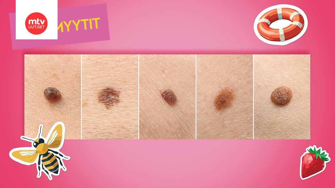 Kehittyykö ihosyöpä aina olemassa olevaan luomeen? | MTV Uutiset