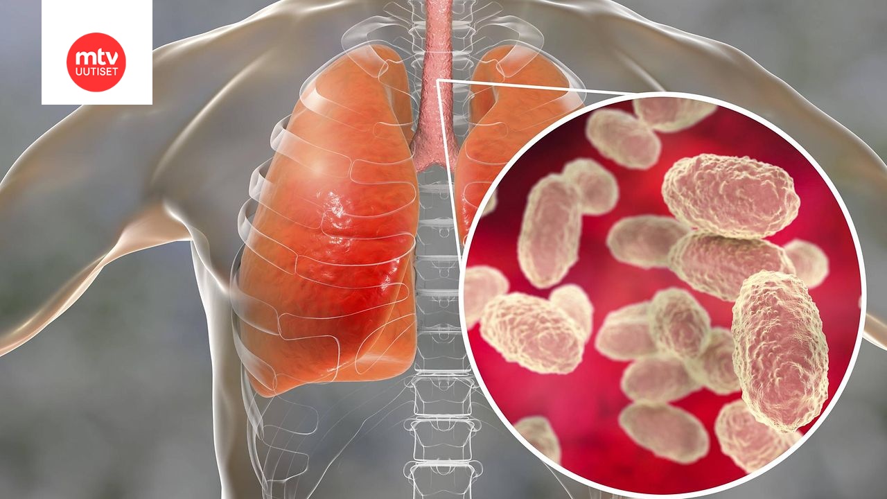 Nämä ovat hinkuyskän oireet | MTV Uutiset