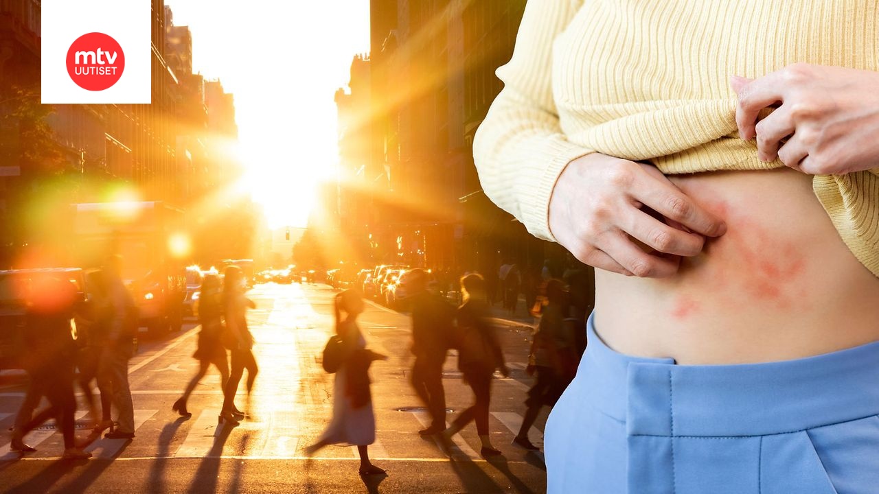 Aurinko voi aktivoida vyöruusun vesirokon sairastaneilla | MTV Uutiset