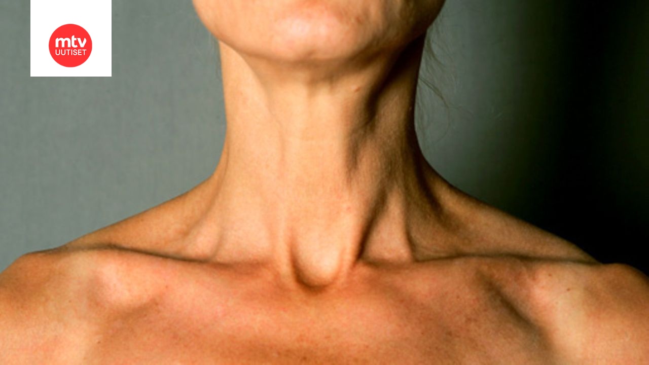 Refluksitauti ei katso ikää tai painoa | MTV Uutiset